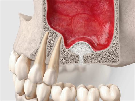 Sinus Floor Elevation Lateral And Transcrestal Approach