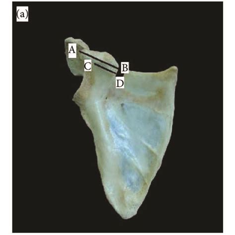 Axial Ct Scan Images Showing The Measurement Of The Tip Of The Coracoid Download Scientific