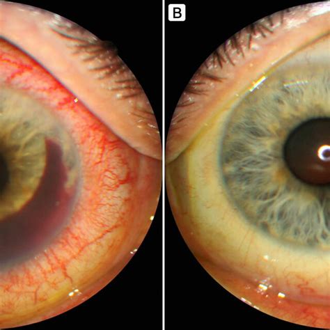 Anterior Segment Photographs Of The Right Eye A And The Left Eye B