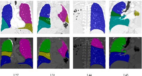 Figure 1 From Lung Lobe Segmentation Based On Lung Fissure Surface