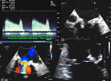 Echocardiographic Imaging Of A Patient With A Mitral Bioprosthesis And