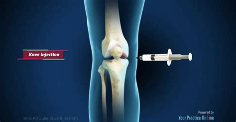 Intra Articular Knee Injections Michigan Knee Institute