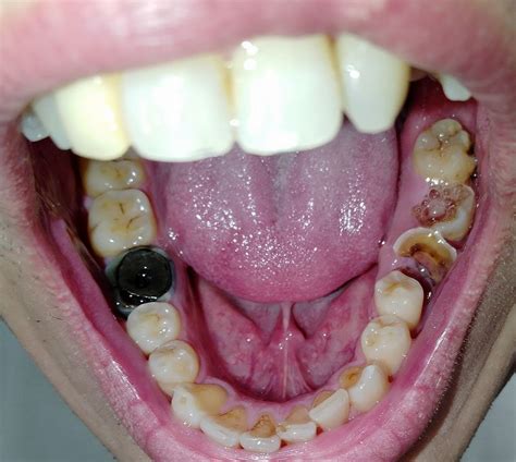 00 虫歯だらけ！歯医者が嫌いで虫歯を放置、治療途中で逃げると口の中はこうなる【静脈内鎮静法 体験記】 病気の治療・経験まとめサイト