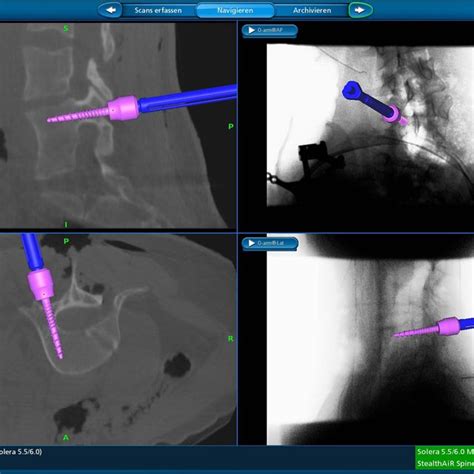 Final Fluoroscopy Image In Ap And Lateral View Download Scientific