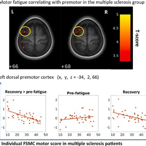 Fatigue Induced Premotor Activity Correlated With Self Reported Motor Download Scientific