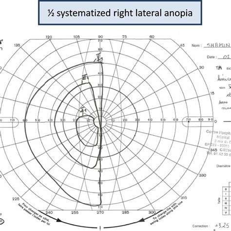 Cv Goldmann Of The Left Eye With Temporal Hemianopsia Without Macular