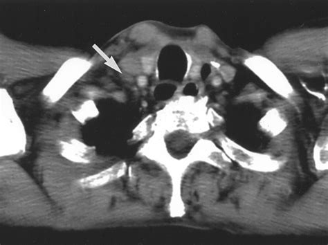 Sonographically Guided Biopsy Of Supraclavicular Lymph Nodes A Simple