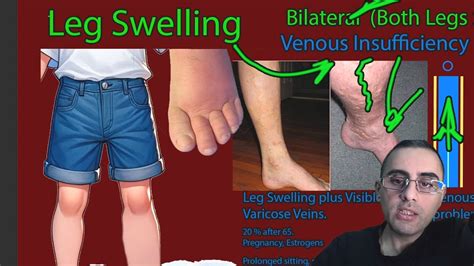 ფეხების შეშუპების მიზეზები ერთ ფეხის შეშუპება Vs ორივე ფეხის შეშუპება Youtube