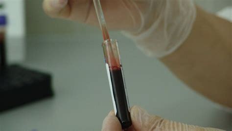 Una Prueba De Sangre Podría Ayudar A Predecir Los Infartos Hasta Tres