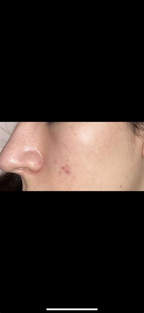 [skin Concerns] Doxycycline Causing Rash R Skincareaddiction