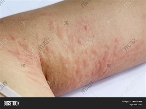 Rash On Upper Arm