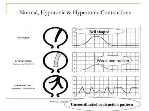 Wikiassessment Of Uterine Contractions 2011