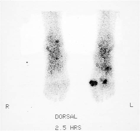 Three Phase Bone Scan Revealing Increased Uptake At The Third Download Scientific Diagram