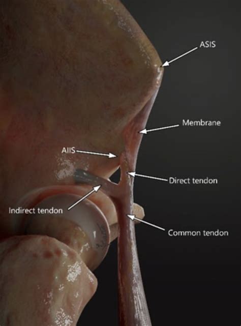 OPEN ACCESS Understanding THE RECTUS FEMORIS ANATOMY DIAGNOSIS TYPES OF INJURY FMPA