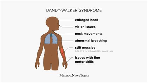 Dandy Walker Syndrome Symptoms Causes And More
