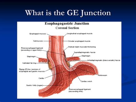 Ppt Gastroesophogeal Adenocarcinoma A Distinct Clinical Entity