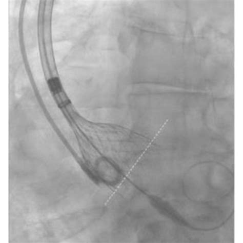 Thv Implantation In Conventional 3 Cusp Coplanar View A 3 Cusp