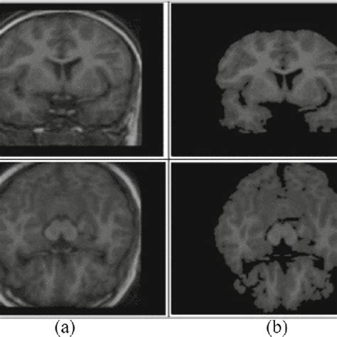 Pdf Brain Tumor Detection And Classification Using Machine Learning