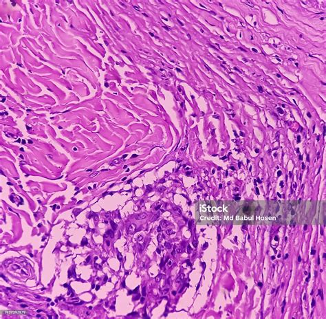 Thyroid Cancer Microscopic Image Of Follicular Neoplasm Malignant