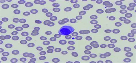 In The Peripheral Smear A Plasma Cell With Basophilic Cytoplasm And A