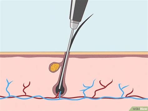 การกำจัดขนก่อนผ่าตัดแปลงเพศ คำแนะนำจาก นพ เชฏฐสัก