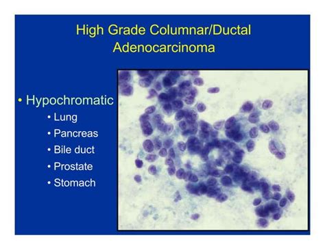 Fna Cytology Of Metastatic Malignancies Ppt
