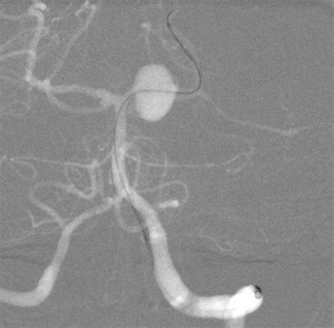Left Sca Aneurysm Pipeline Embolization Left Radial Accesss
