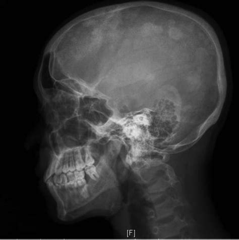 Focal Osteosclerosis Of The Skull In Primary Hyperparathyroidism Bmj Case Reports
