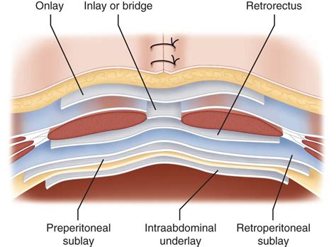 Ventral Hernia And Abdominal Release Procedures Clinical Tree