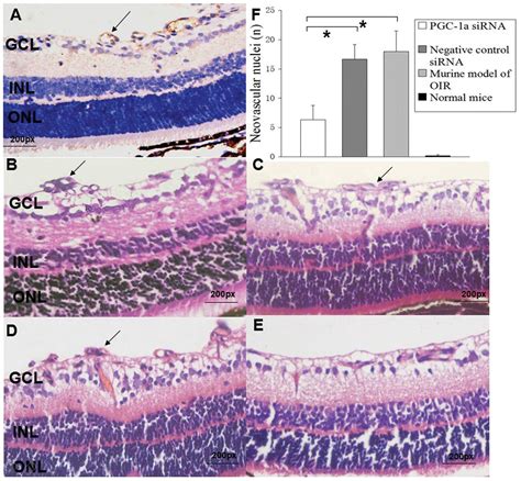 Neovascularization Of The Disc