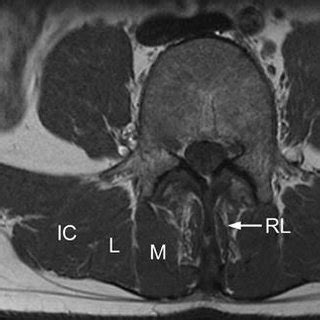 Anatomy Of The Intrinsic Back Muscles Line Diagram Of Axial Section At
