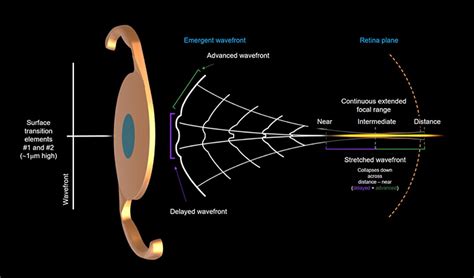 Classification Of A Wavefront Shaping Intraocular Lens Opth