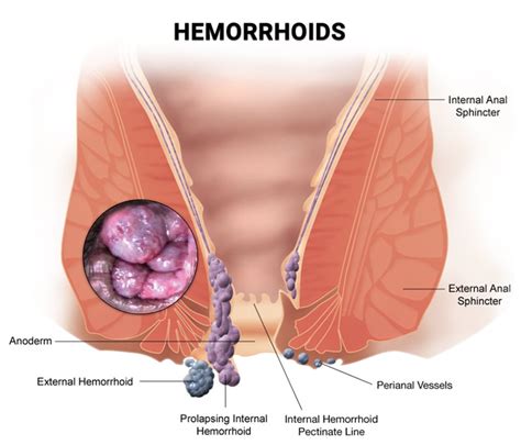 External Hemorrhoid With Rash