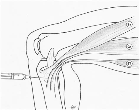 Injection Or Aspiration Of Pes Anserine Bursa Gpnotebook Gpnotebook