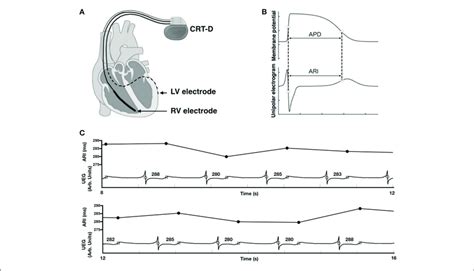 A Cardiac Resynchronization Therapy Defibrillator Crt D Device