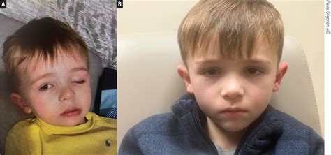 Botox For Treatment Of Strabismus