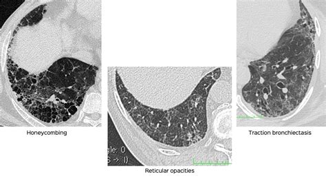 Lecture Fibrosing Ilds Understanding Reticular Opacities Traction Bronchiectasis And