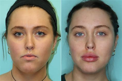 Lip Plastic Surgery Before And After Edneu