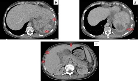 Disseminated Fungal Infection With Saprochaete Capitata In Acute