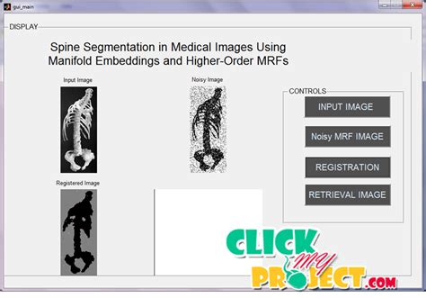 Spine Segmentation In Medical Images Usingmanifold Embeddings And