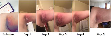 Bug Bite Vs Staph Infection