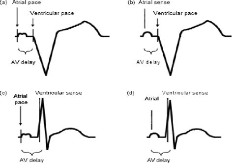 figure 1 from implementation of low delay dual chamber pacemaker using verilog semantic scholar