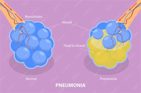 D Illustration Vectorielle Plate Isométrique De Linfection Pulmonaire