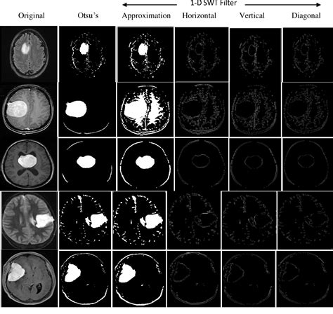 Figure 1 From Brain Tumor Detection And Classification Based On Hybrid