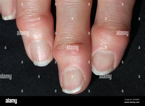 Deformed Fingers Of The Hand In A 65 Year Old Female Patient Due To