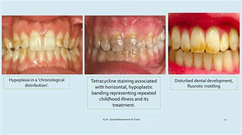 Anomalies Of Tooth Formation And Eruption Pptx