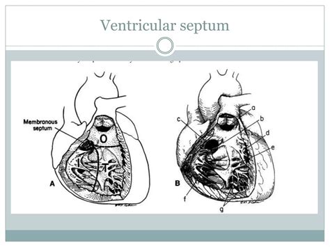 Ventricular Septal Defects Pptx