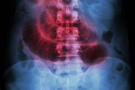Traitement Naturel De Locclusion Intestinale Remèdes Et Prévention Icm46