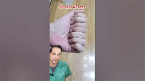 Polydactyly Extra Fingers Occurs In 1750 Live Births Extra Finger