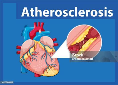 Pendidikan Ipa Anatomi Manusia Dan Infografis Aterosklerosis Ilustrasi Stok Unduh Gambar